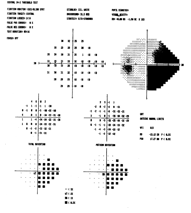 What Is A Visual Field Test NovaVision